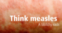 Think measles! - Birmingham and Solihull Mental Health NHS Foundation Trust